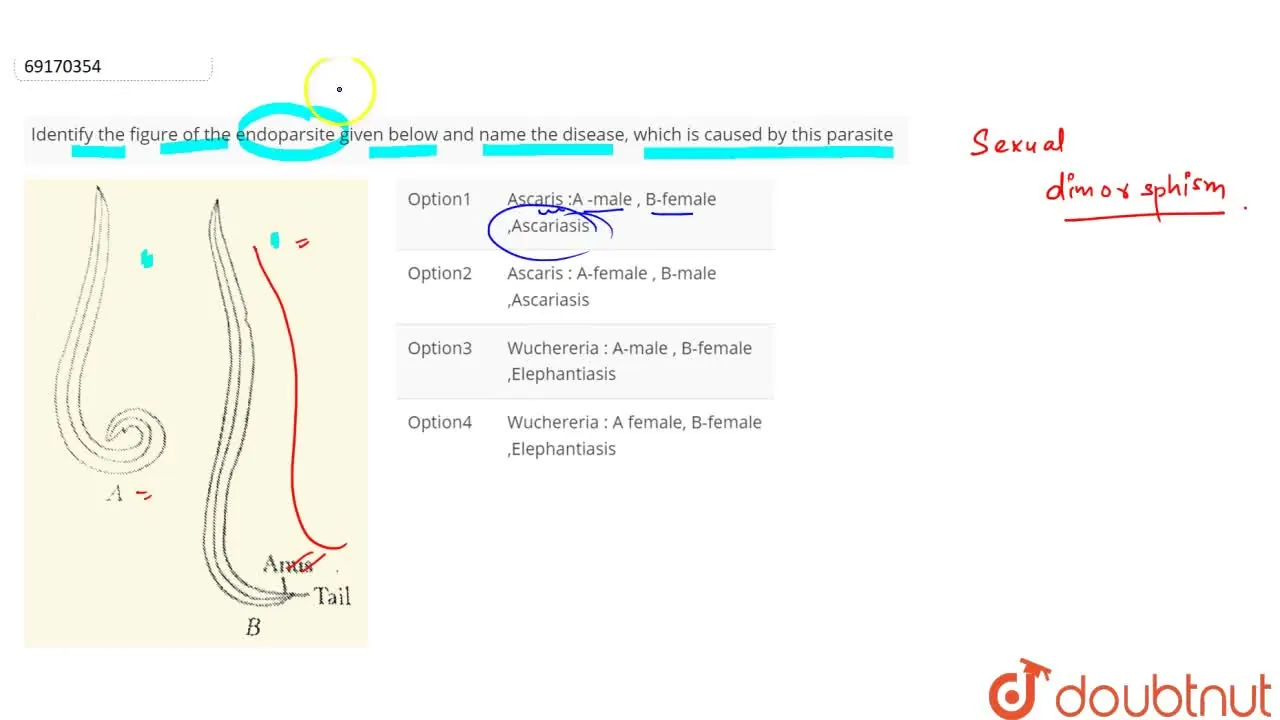 Wuchereria : A-male , B-female ,Elephantiasis