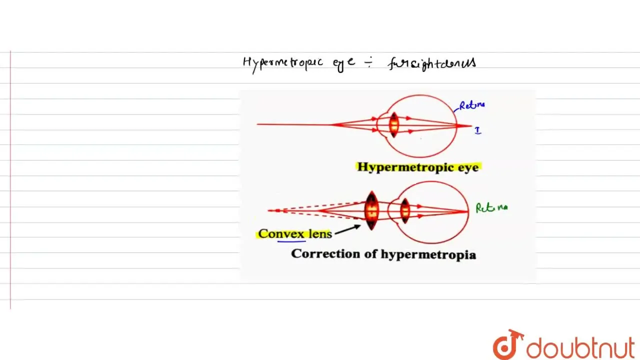 Draw neat labelled diagram of a hypermetropic eye and its correction.